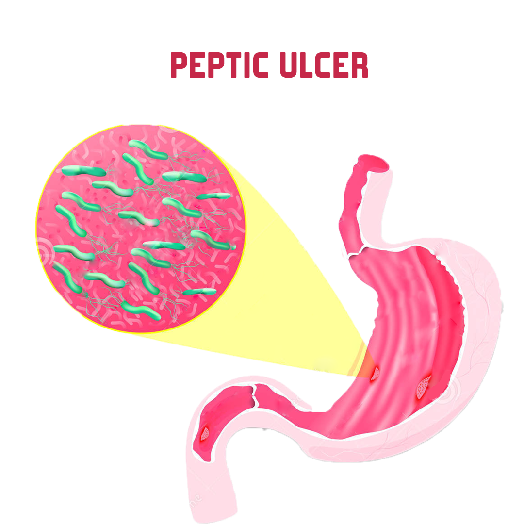 Peptic Ulcer Treatment & Gastric Ulcer Hospital in Coimbatore